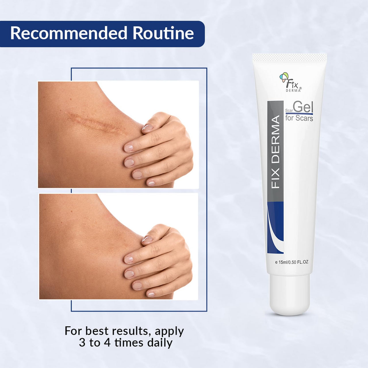 Fixderma Scar gel, Reduces Acne Scars, Surgery Scars, Injury Scars, Bu ...
